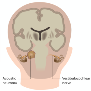 Home - Michigan Ear Institute Acoustic Neuroma Center